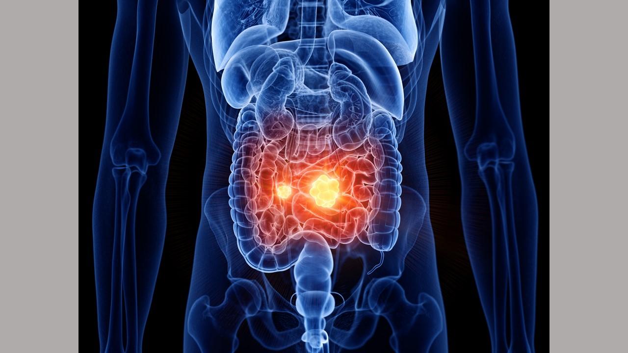 Transcription Factors Contribute to Subtypes of Colorectal Cancers ... Transcription Factors Contribute to Subtypes of Colorectal Cancers ...